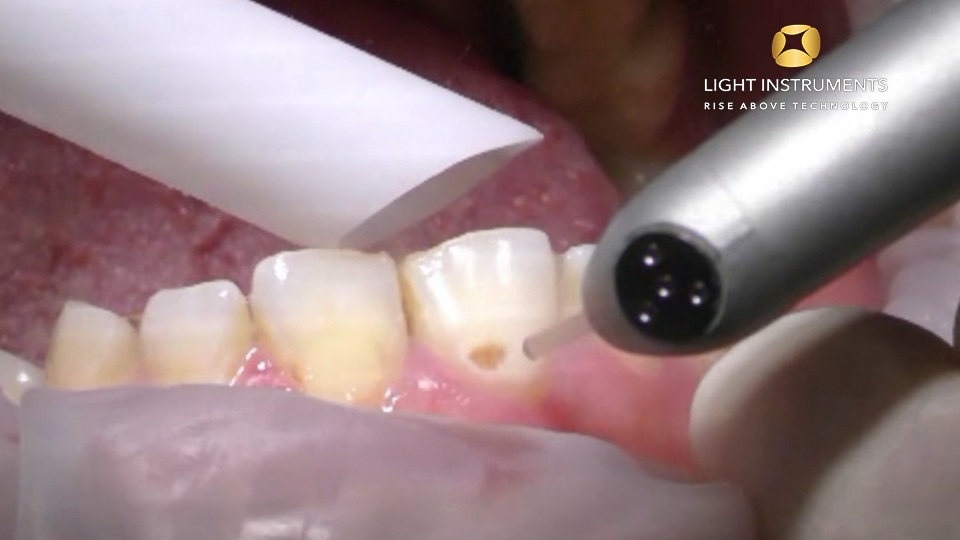 Restorative Dentistry with the LiteTouch™ Er:YAG | Light Instruments Ltd.